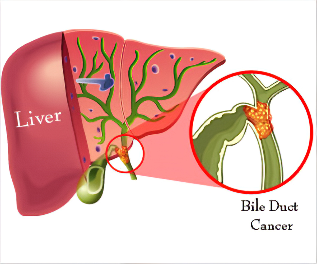 Duct Cancer Evaluation In Situ - Review - Biologyforum